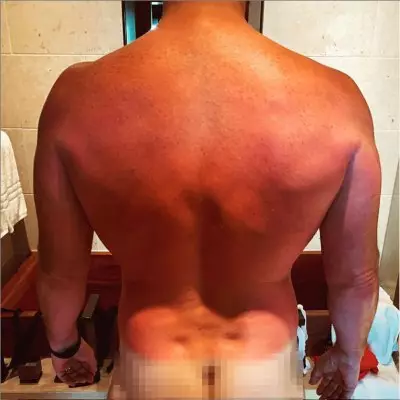 UChris Pratt's Sunburned Back and White Butt