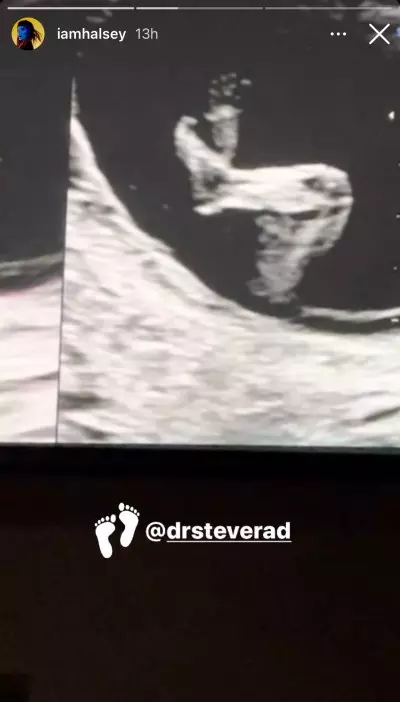 halsey-ultrasound-mimba-ig