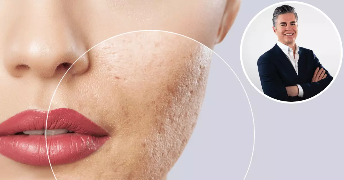 Como evitar cicatrices de acne, segundo os mellores dermatólogos