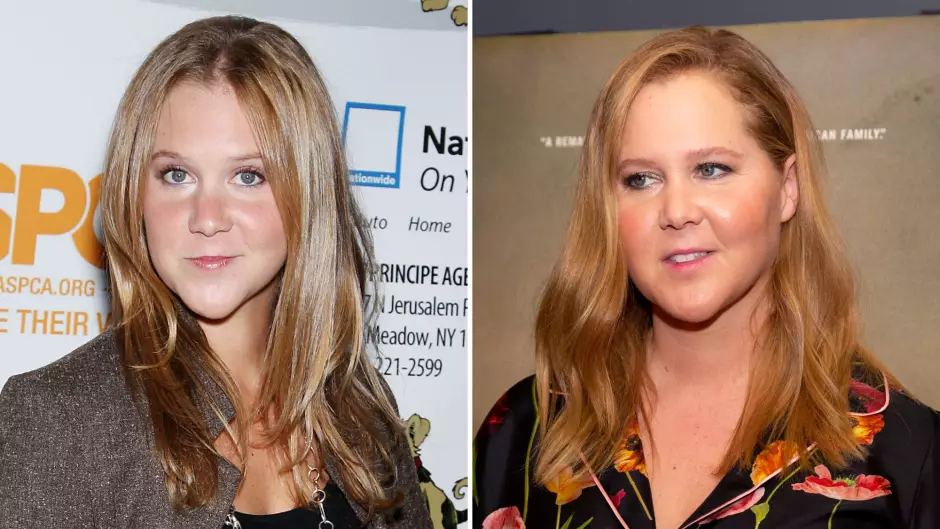 Amy Schumer ทำศัลยกรรมพลาสติกหรือไม่? ภาพถ่ายการเปลี่ยนแปลง