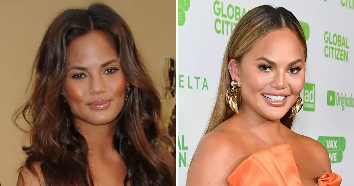 Chrissy Teigen prima e dopo: la modella ha subito un intervento di chirurgia plastica?