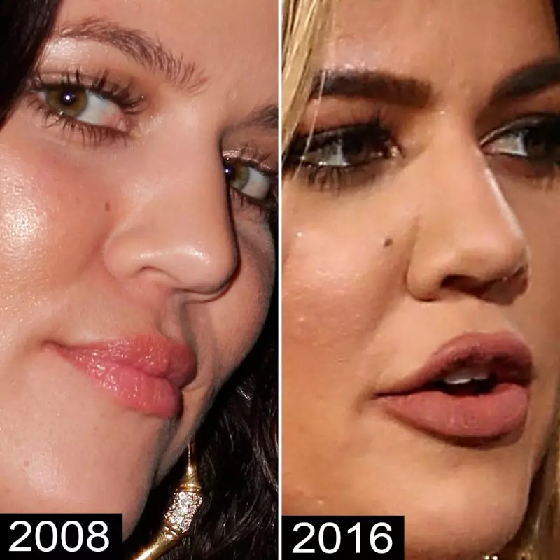 Khloe kardashian burun bucağı 2