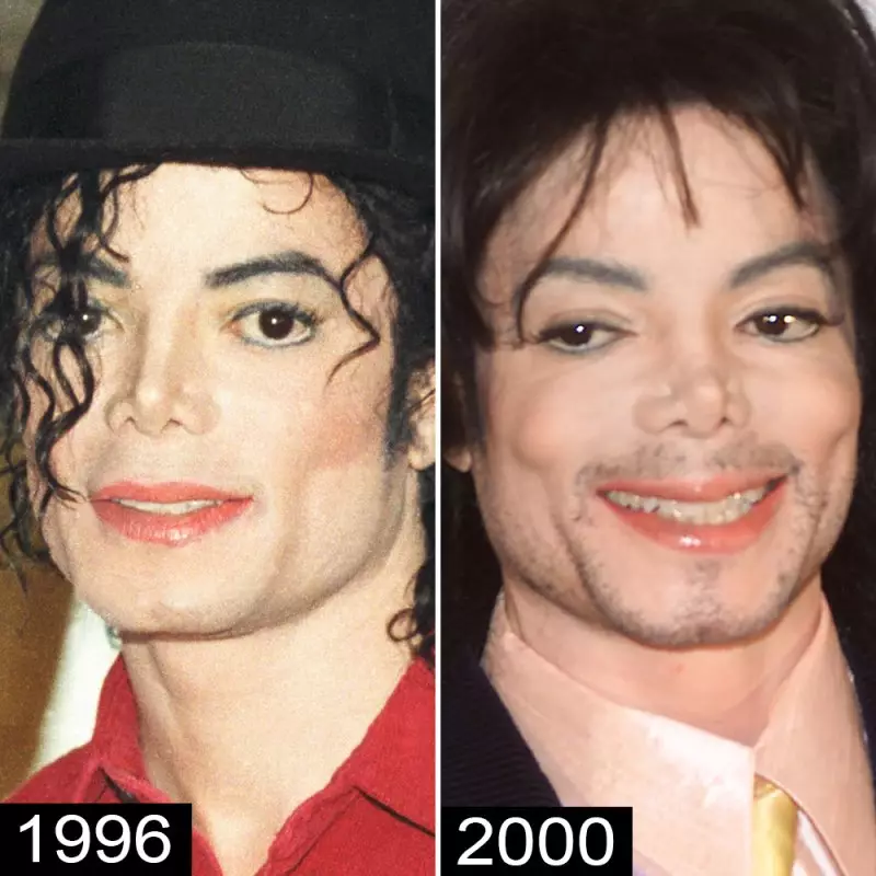 Plastická chirurgia Michaela Jacksona 8