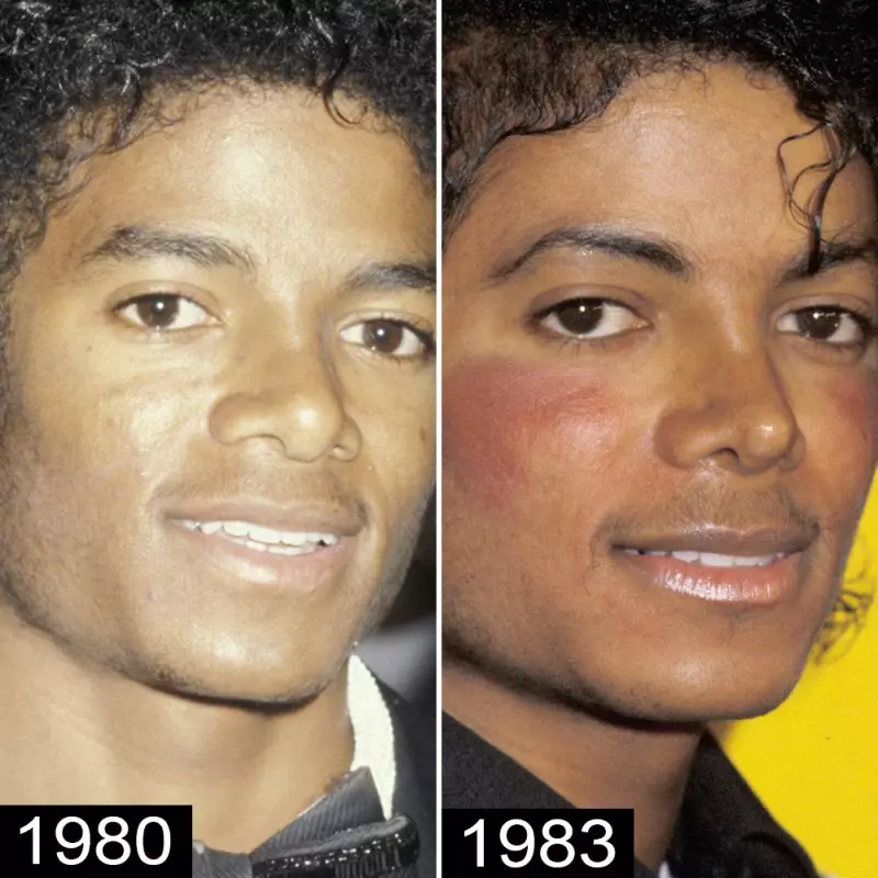 ការងារច្រមុះរបស់ Michael Jackson ៣