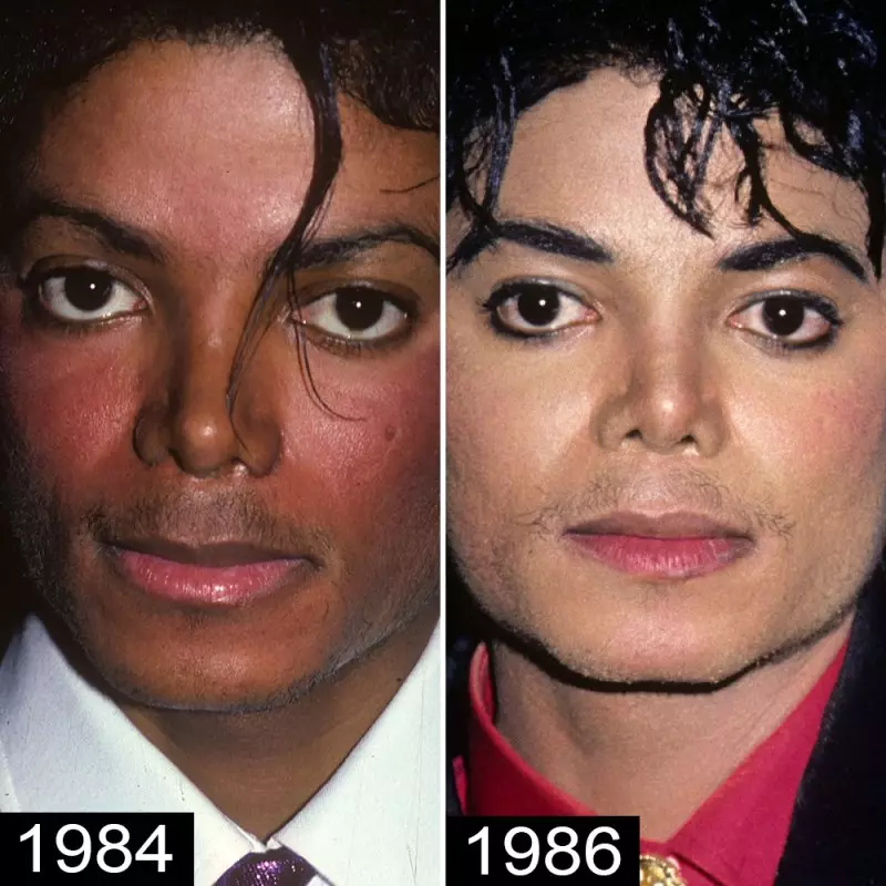 Третья пластика носа у Майкла Джексона