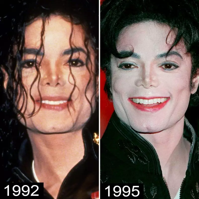 Chirurgia plastica Michael Jackson 6