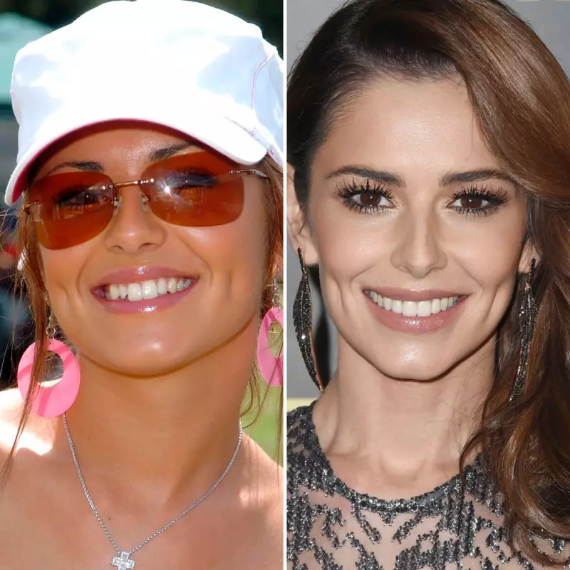 Cheryl cole veneers