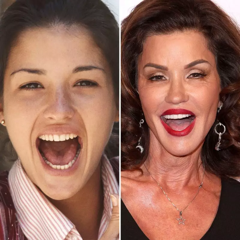 Janice dickinson veneers