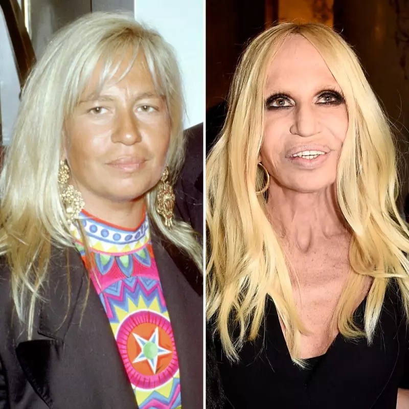 Donatella versace opereishene ea polasetiki