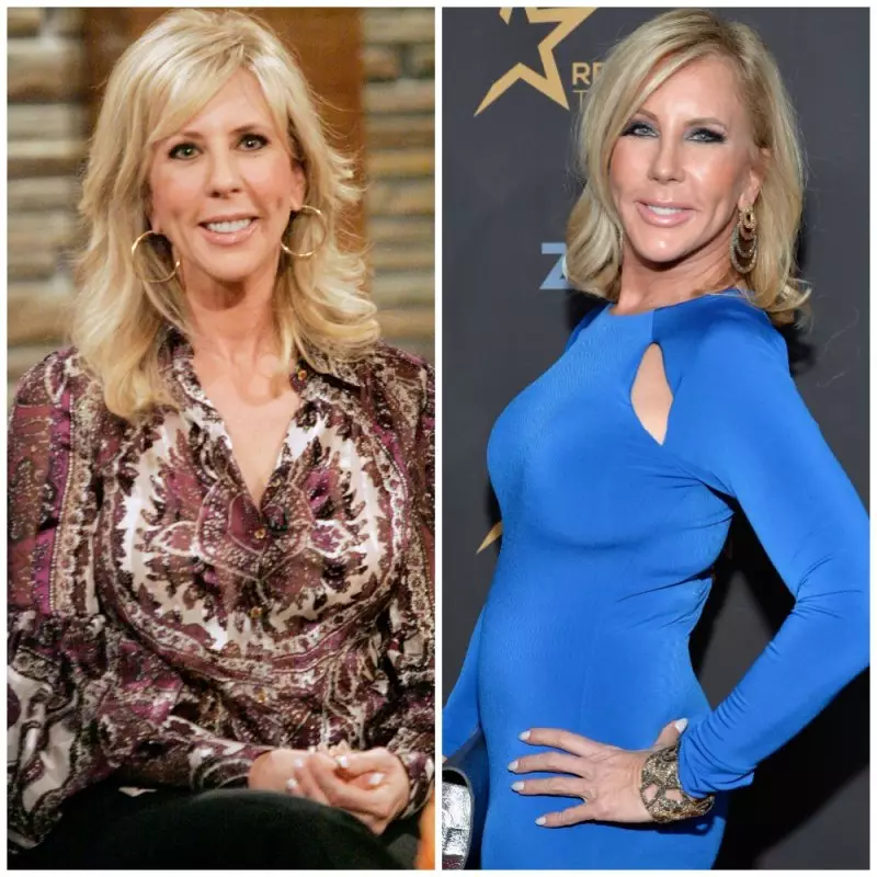 แม่บ้านทำศัลยกรรม vicki gunvalson