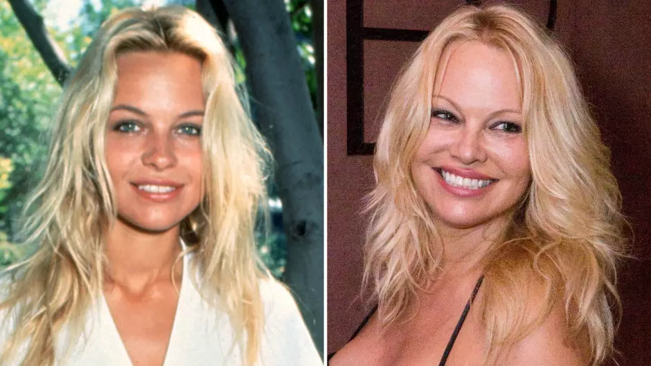 Har Pamela Anderson fått plastisk kirurgi? Se 'Baywatch' Alum da og nå!