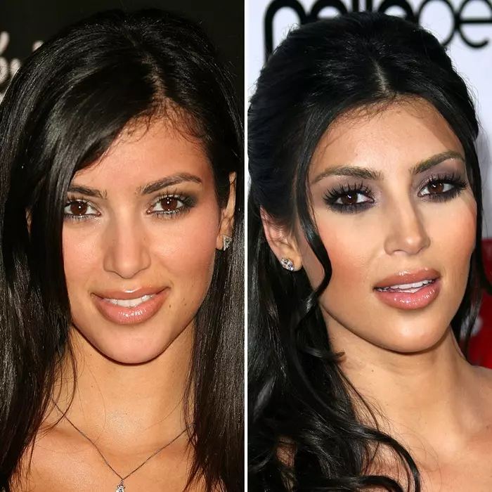 bedah plastik kim kardashian