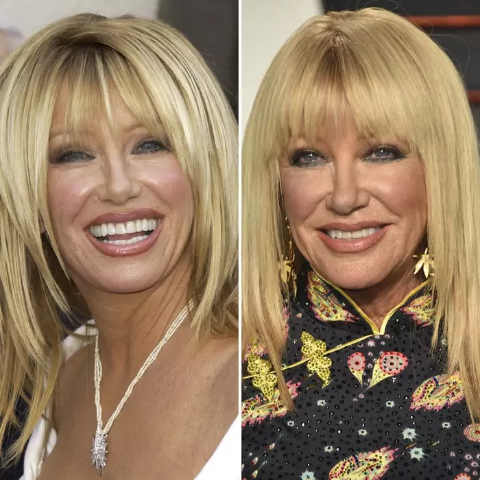 Plasztikai sebészet suzanne somers másolata