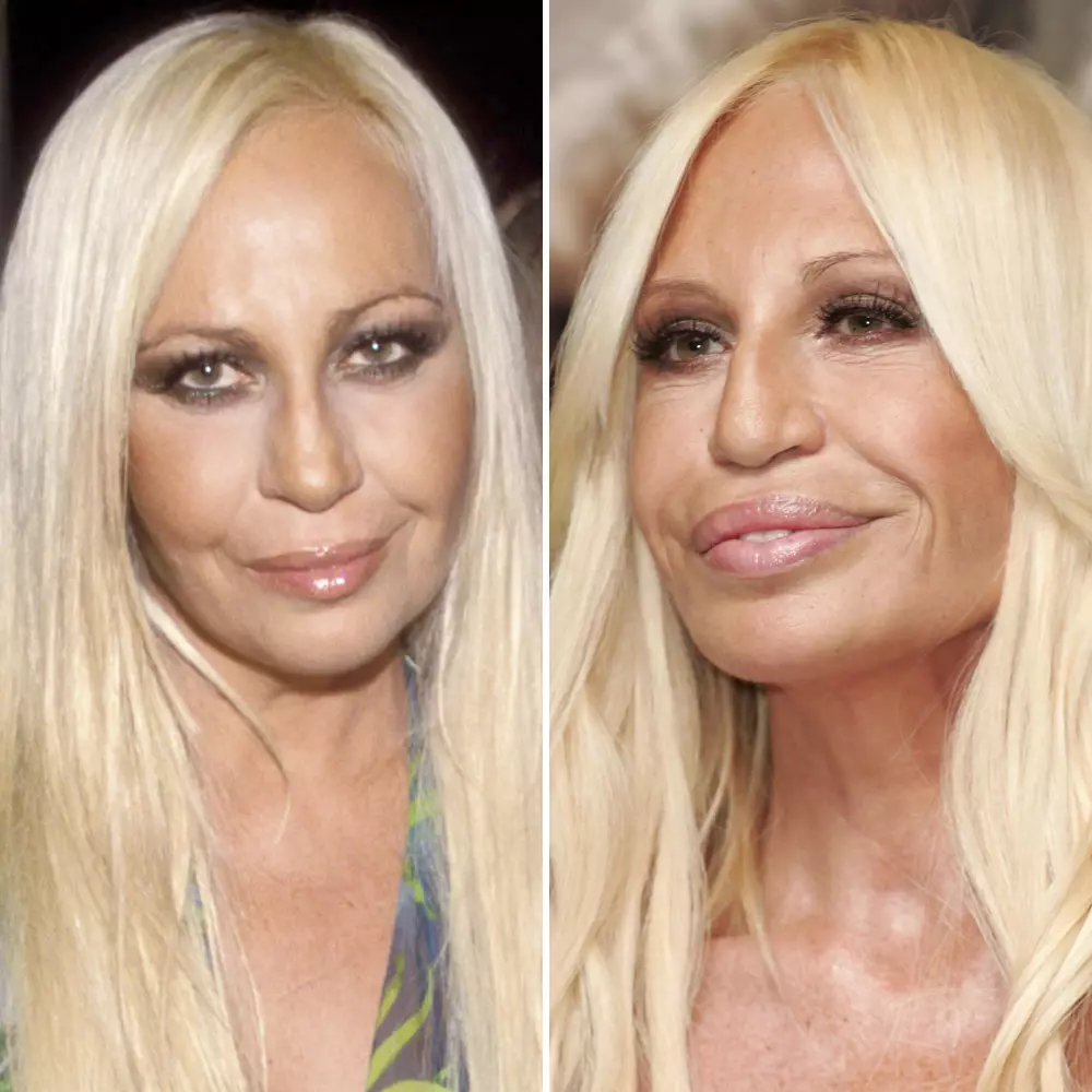 Operasi Donatella versace