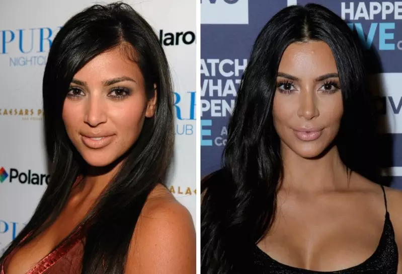 Kim Kardashian plastik jarrohlikdan oldin va keyin