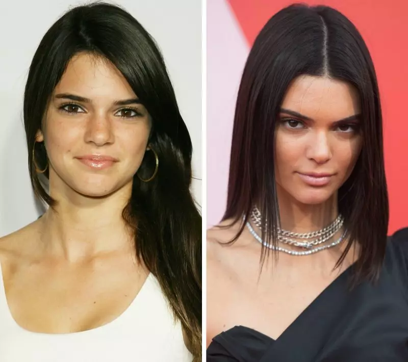 Kendall jenner para dhe pas operacionit plastik