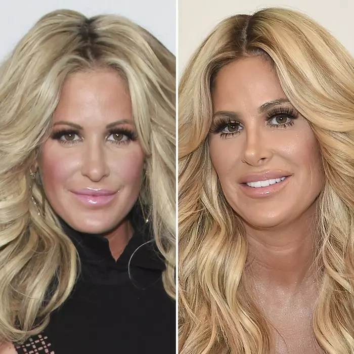 Plastiskā ķirurģija kim zolciak