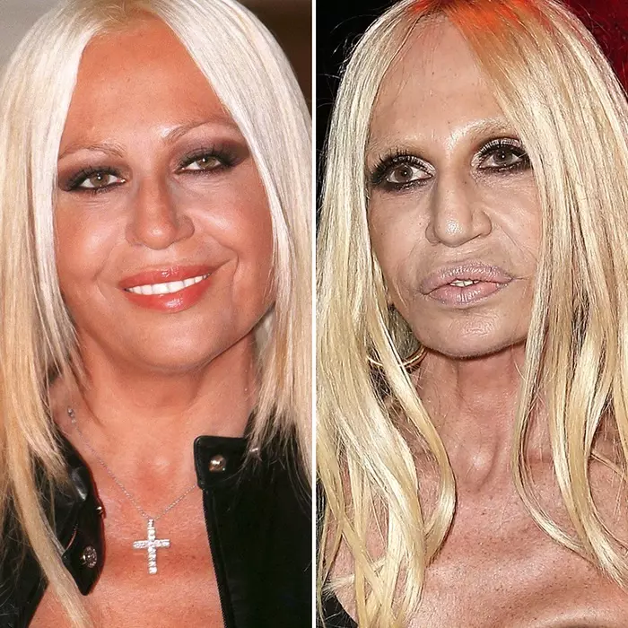 Plastik cərrahiyyə donatella versace surəti