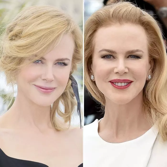 Nicole Kidman chirurgie plastică