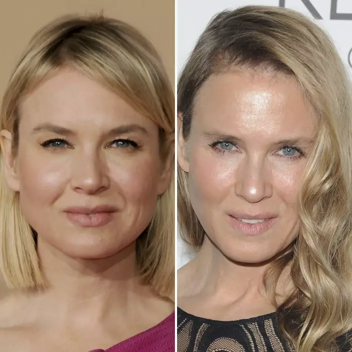 پىلاستىك ئوپراتسىيە renee zellweger