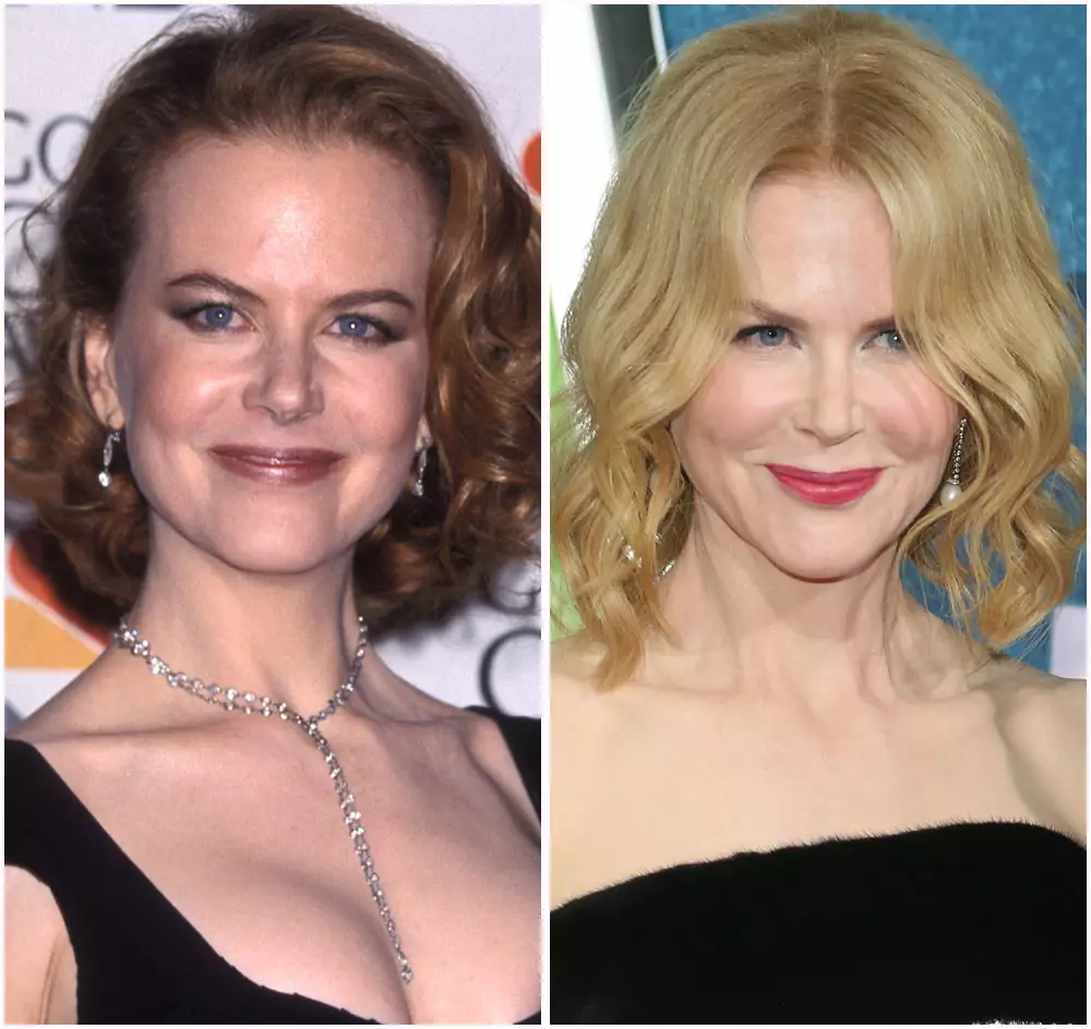 Cirurgia Plástica Nicole Kidman