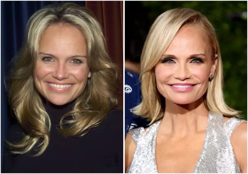 Η Kristin Chenoweth πλαστική χειρουργική