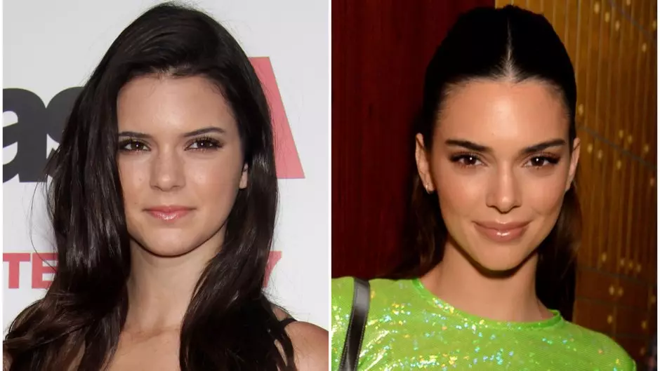 kendall-jenner-plastic-surgery-tanan-nga iyang gisulti