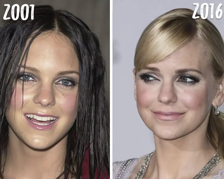 Transformation du nez d'Anna Faris