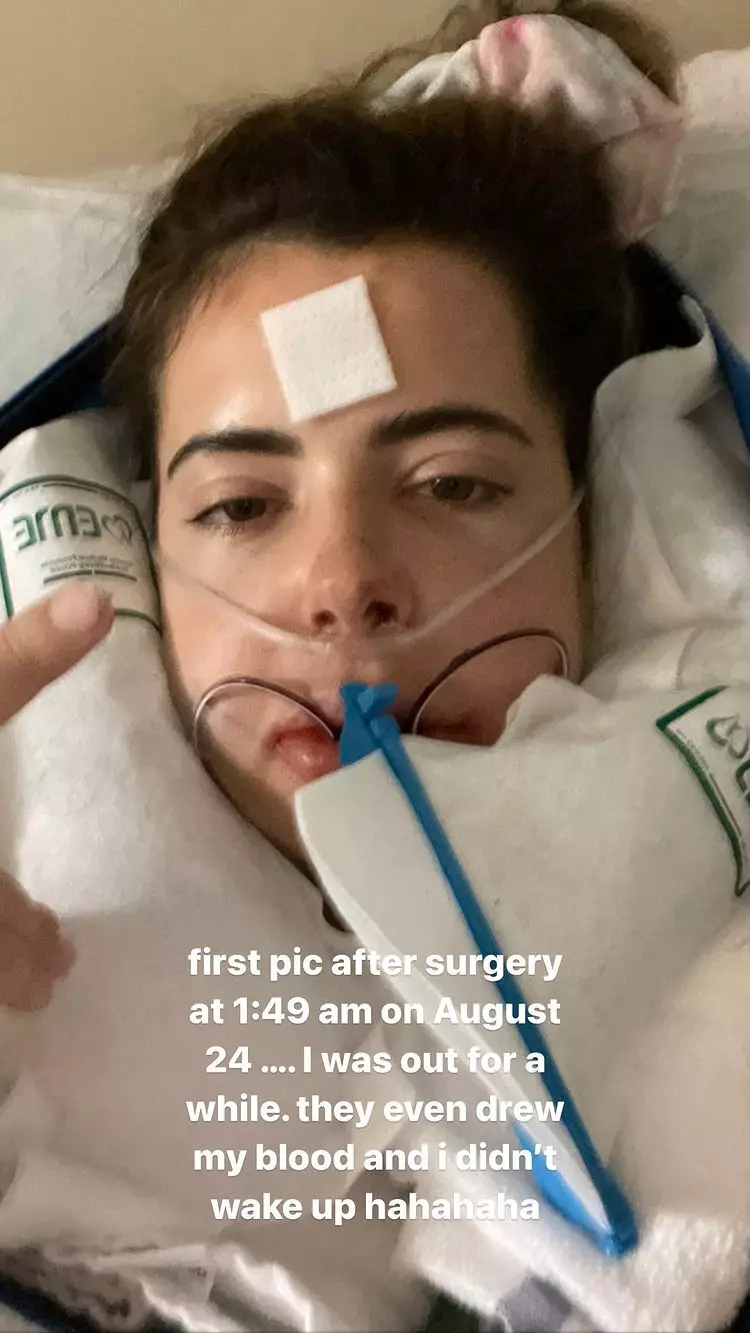 Ang Double Jaw Surgery ni Brielle Biermann: Sa wala pa ug Pagkahuman sa Mga Litrato 2