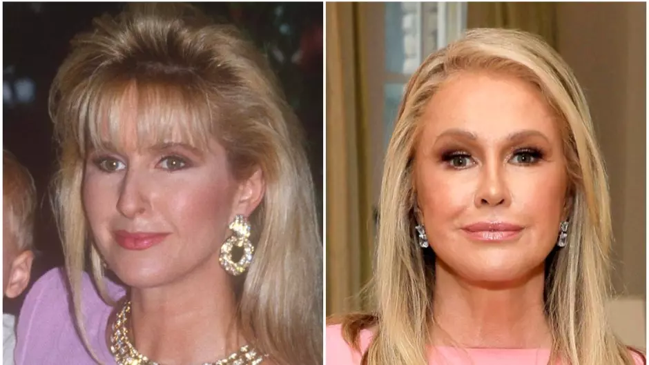 kathy-hilton-plasztikai sebészet